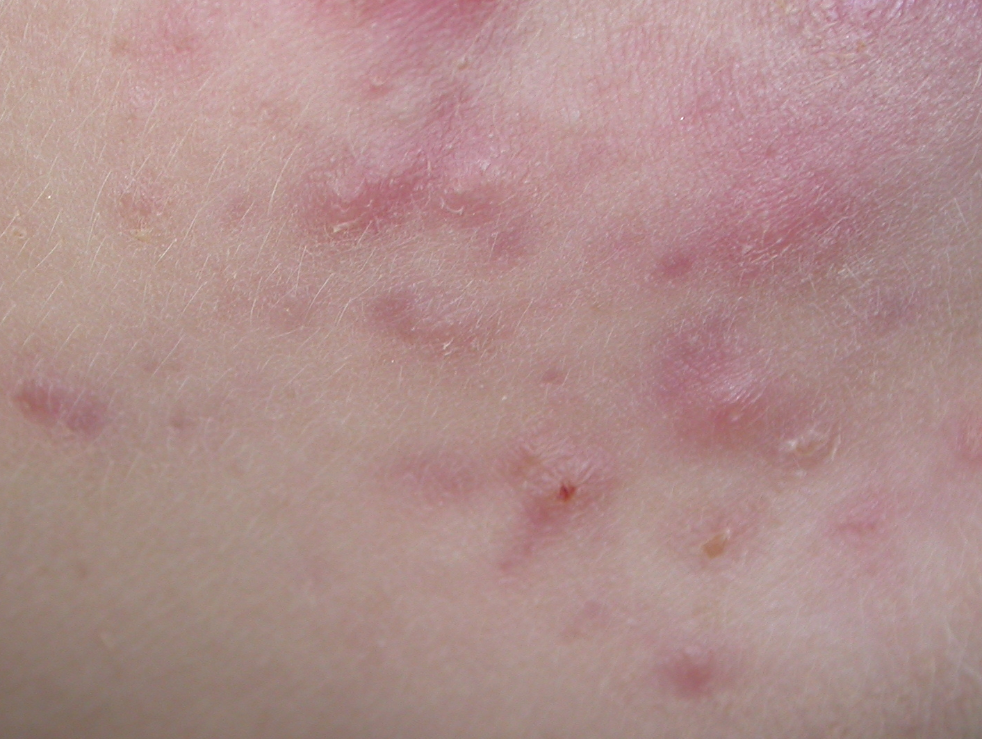 Spots/Acne - Dr Jonathan Bowling