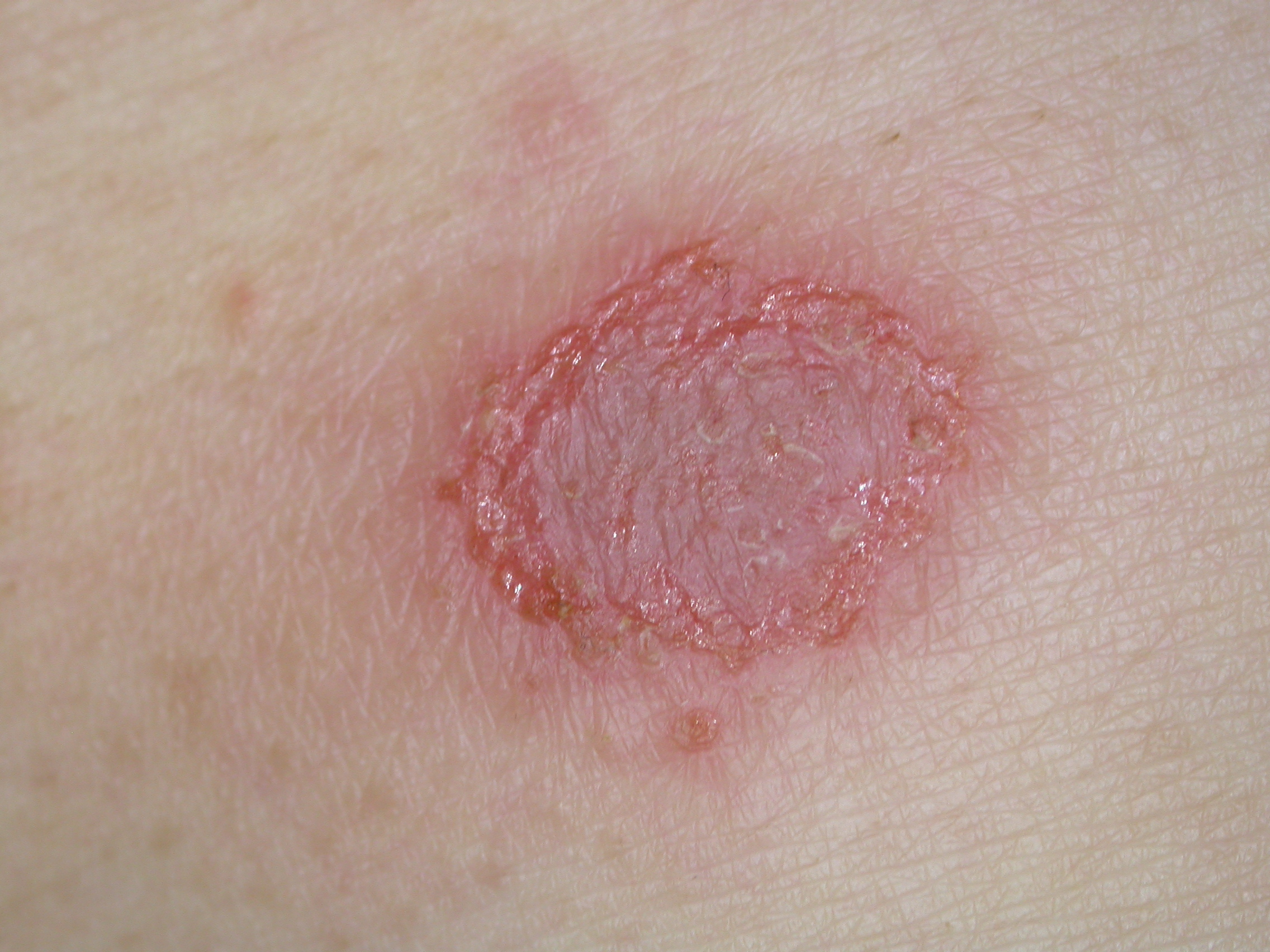 Eczema - Dr Jonathan Bowling